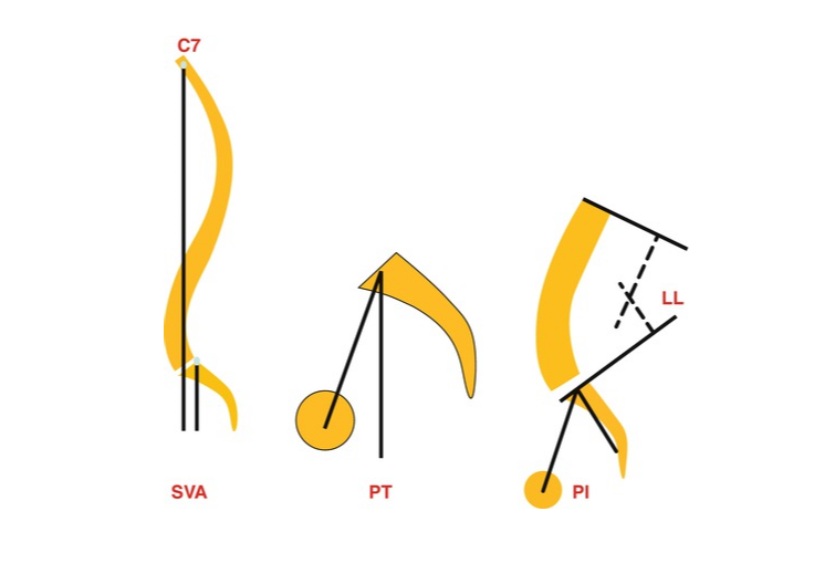 Классификация SRS-Schwab (деформации позвоночника у взрослых) | Никита ...